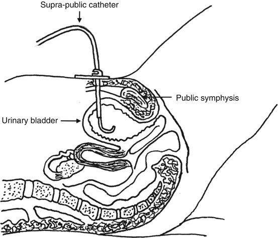 Basics of Rigid Cystoscopy and Techniques of Suprapubic Catheter ...