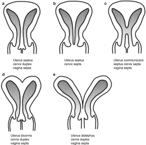 Hysteroscopy in Complex Müllerian Anomalies | SpringerLink