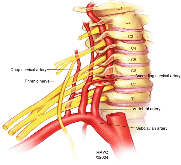 Death After Transforaminal Cervical Epidural Steroid Injection ...