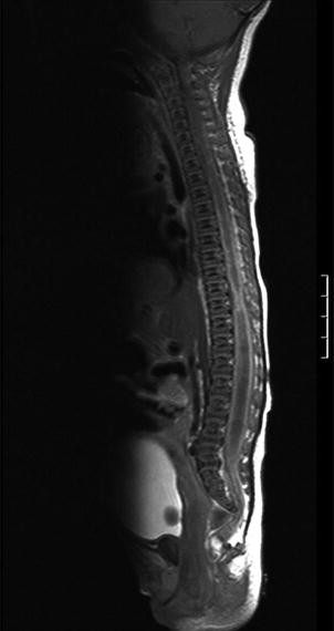 Spinal Subdural Abscesses | SpringerLink