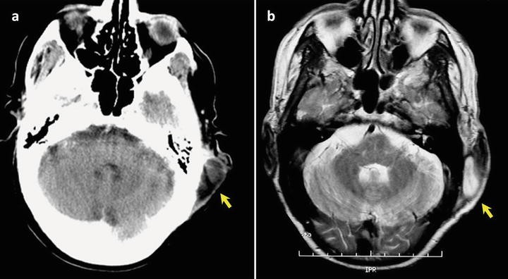 Scalp Abscesses | SpringerLink