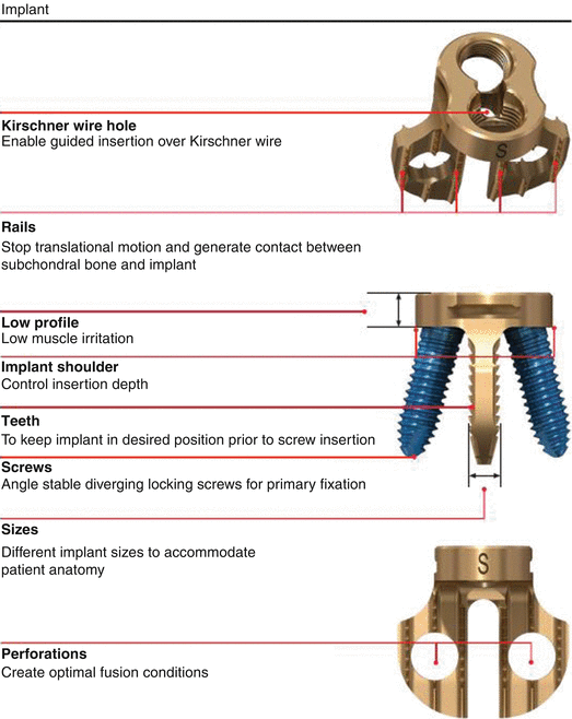 New Techniques and MIS: The Interfacet Fixation with Facet Wedge Device ...
