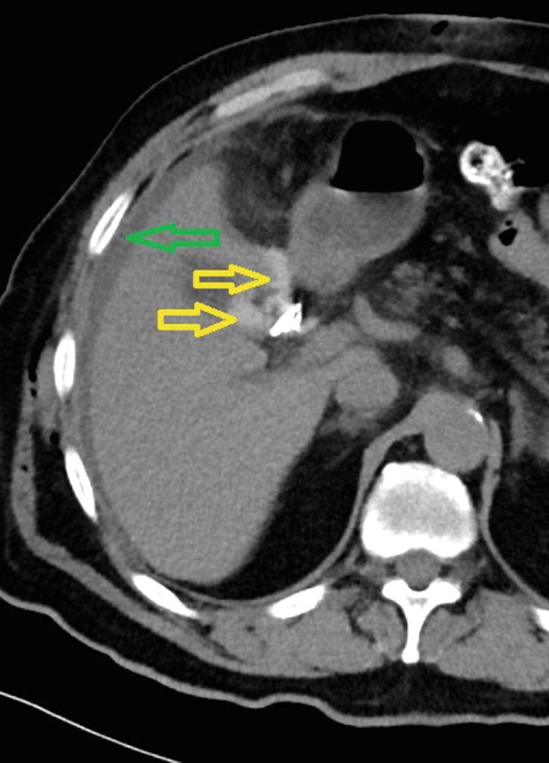 Identification and Management of Bile Leaks Post Cholecystectomy ...