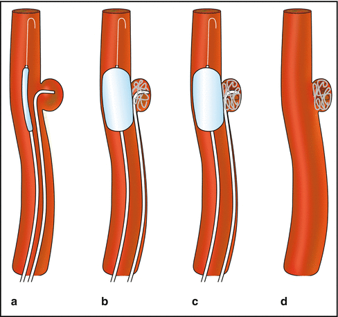 Intracranial Aneurysm Treatment | SpringerLink