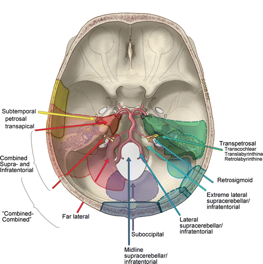 Microsurgical Management of Posterior Fossa Vascular Lesions | SpringerLink