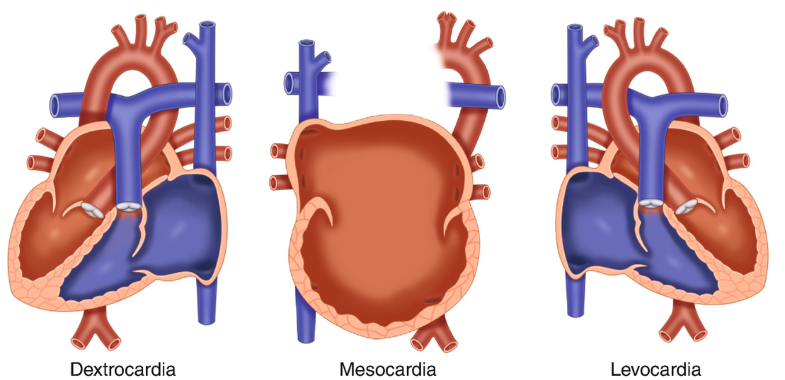 Terminology: Defining Cardiac Position, Chamber Morphology and Van ...