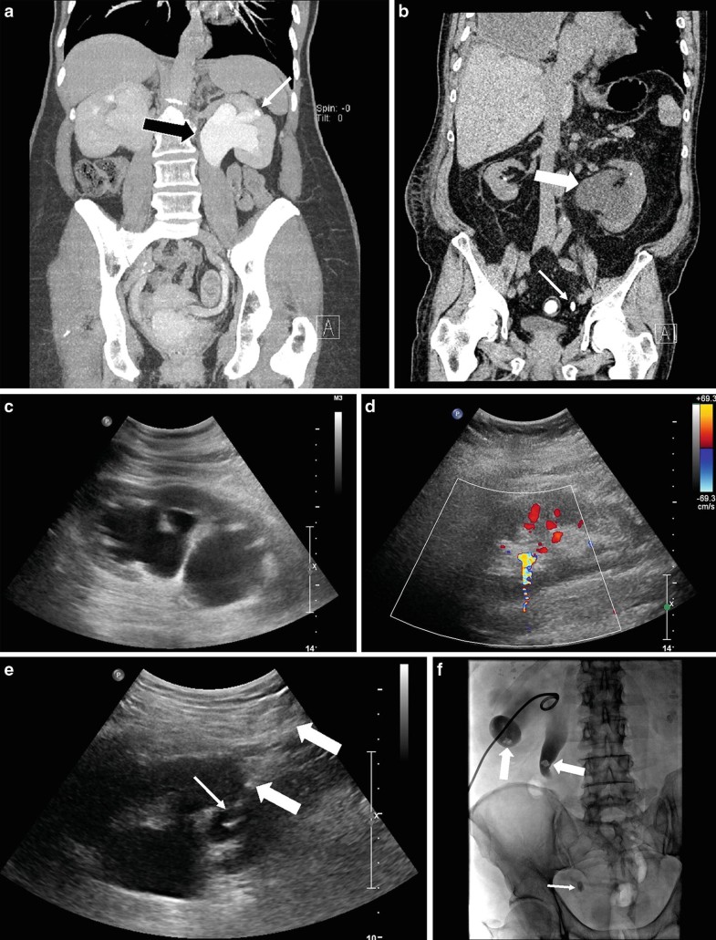 Obstructive Uropathy | SpringerLink