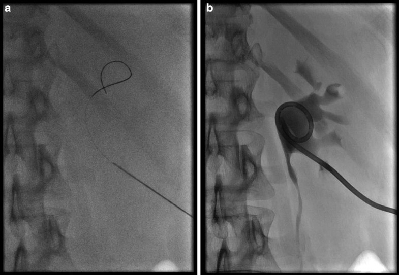 Obstructive Uropathy | SpringerLink