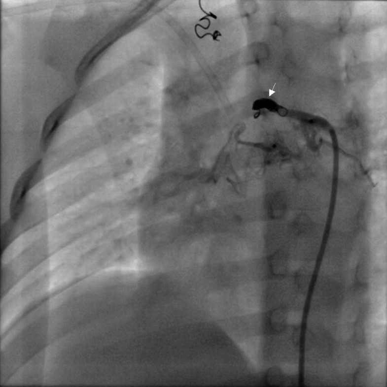 Vessel Embolization: Transcatheter Embolization of Pulmonary ...
