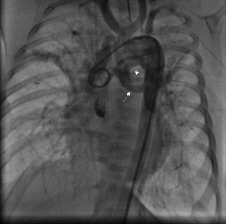 Vessel Embolization: Transcatheter Embolization of Pulmonary ...