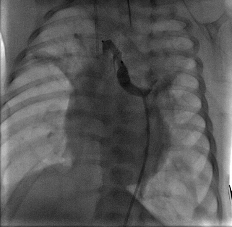 Vessel Embolization: Transcatheter Embolization of Pulmonary ...