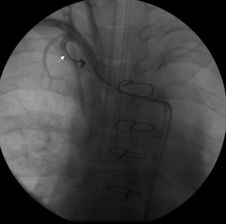 Vessel Embolization: Transcatheter Embolization of Pulmonary ...