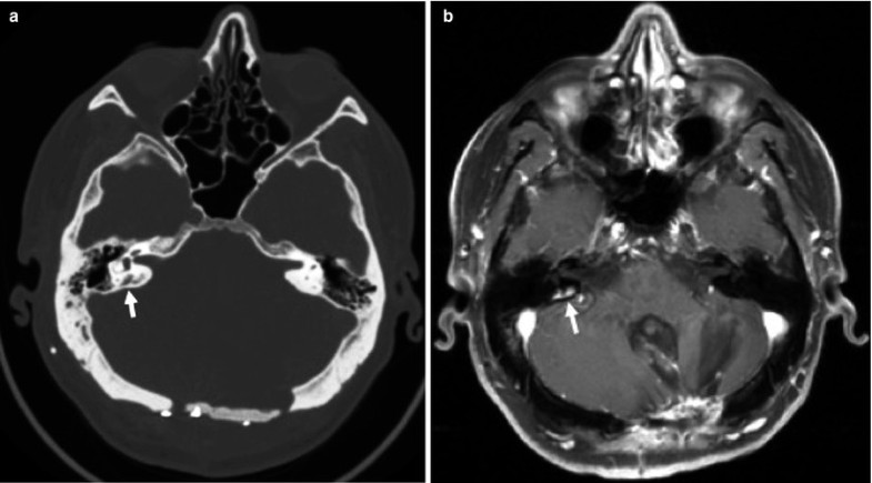 Unusual Tumors of the Temporal Bone | SpringerLink