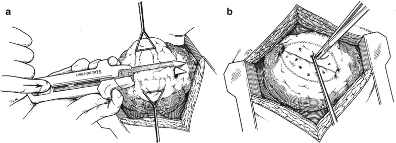 Fundamentals of Exploratory Thoracotomy for Trauma | SpringerLink