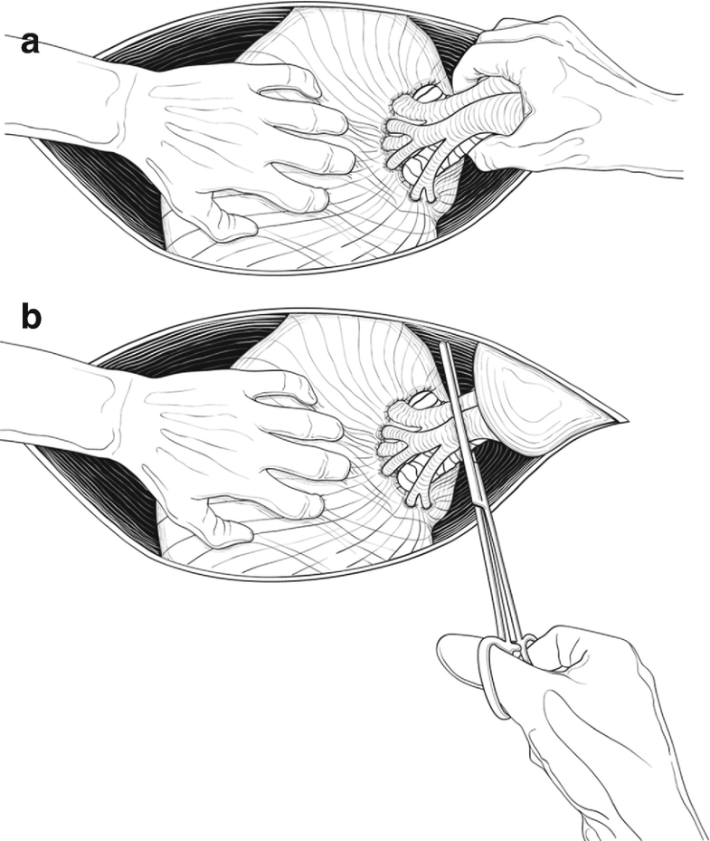 Fundamentals of Exploratory Thoracotomy for Trauma | SpringerLink