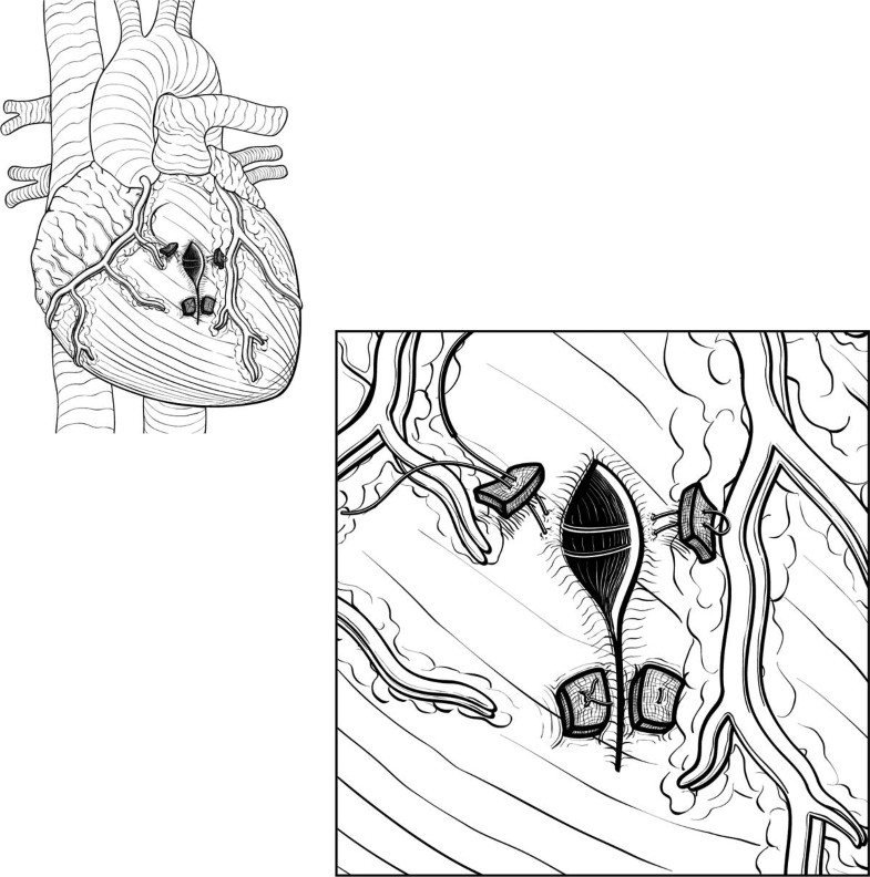 Fundamentals of Exploratory Thoracotomy for Trauma | SpringerLink