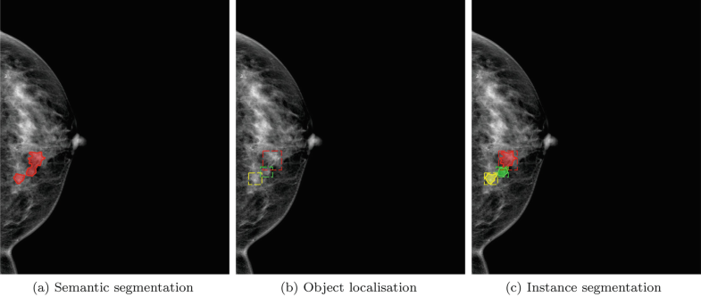 Deep Learning in Breast Cancer Screening | SpringerLink
