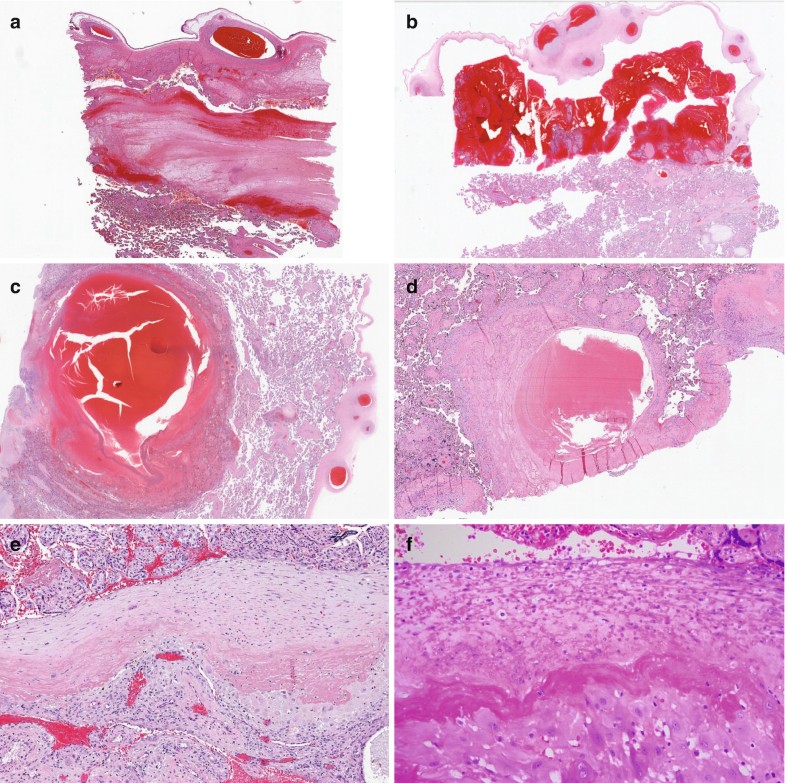 Intervillous Thrombosis | SpringerLink