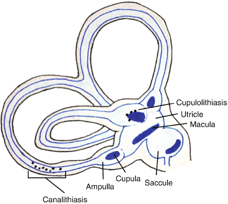 Pathophysiology and Diagnosis of BPPV | SpringerLink
