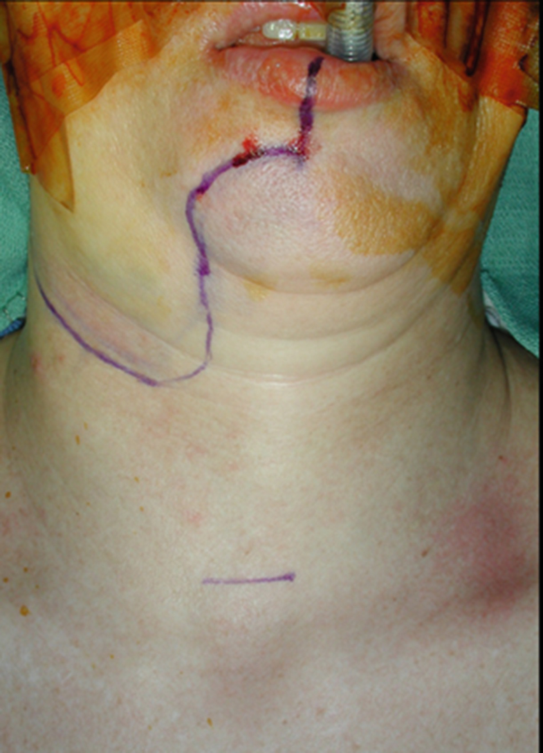 Transmandibular Approach to Craniocervical Spine | SpringerLink