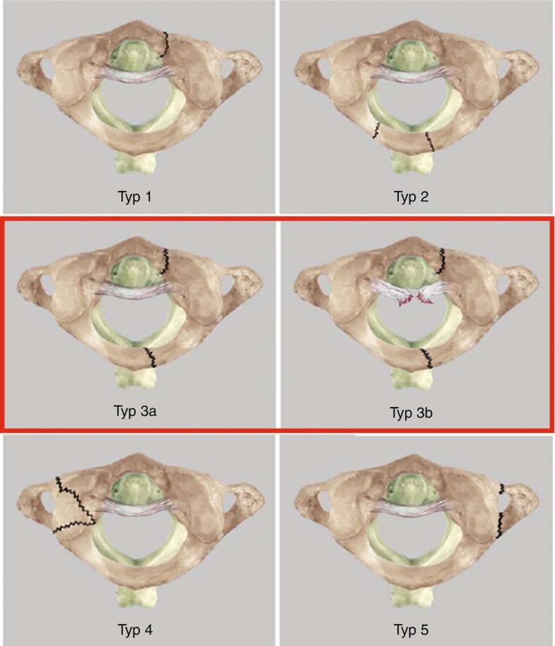 Upper Cervical Spine Trauma | SpringerLink