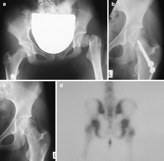 Oberschenkelhalsfrakturen (proximale Femurfrakturen) | SpringerLink