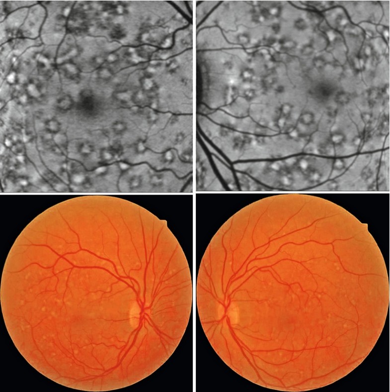 Fundus Autofluorescence Imaging in Retinal Dystrophies | SpringerLink
