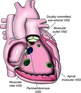 Ventricular Septal Defect | SpringerLink