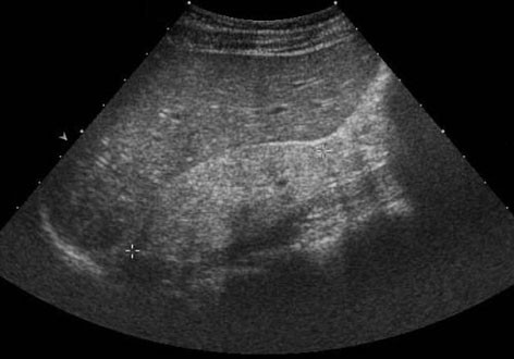 Nephronophthisis and Medullary Cystic Kidney Disease | SpringerLink