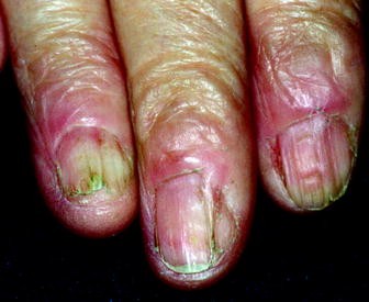 Nail Lichen Planus | SpringerLink