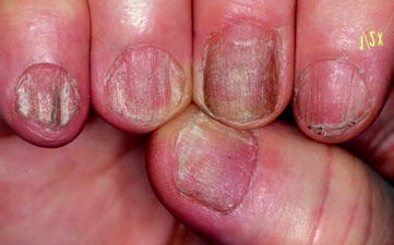 Nail Thinning | SpringerLink