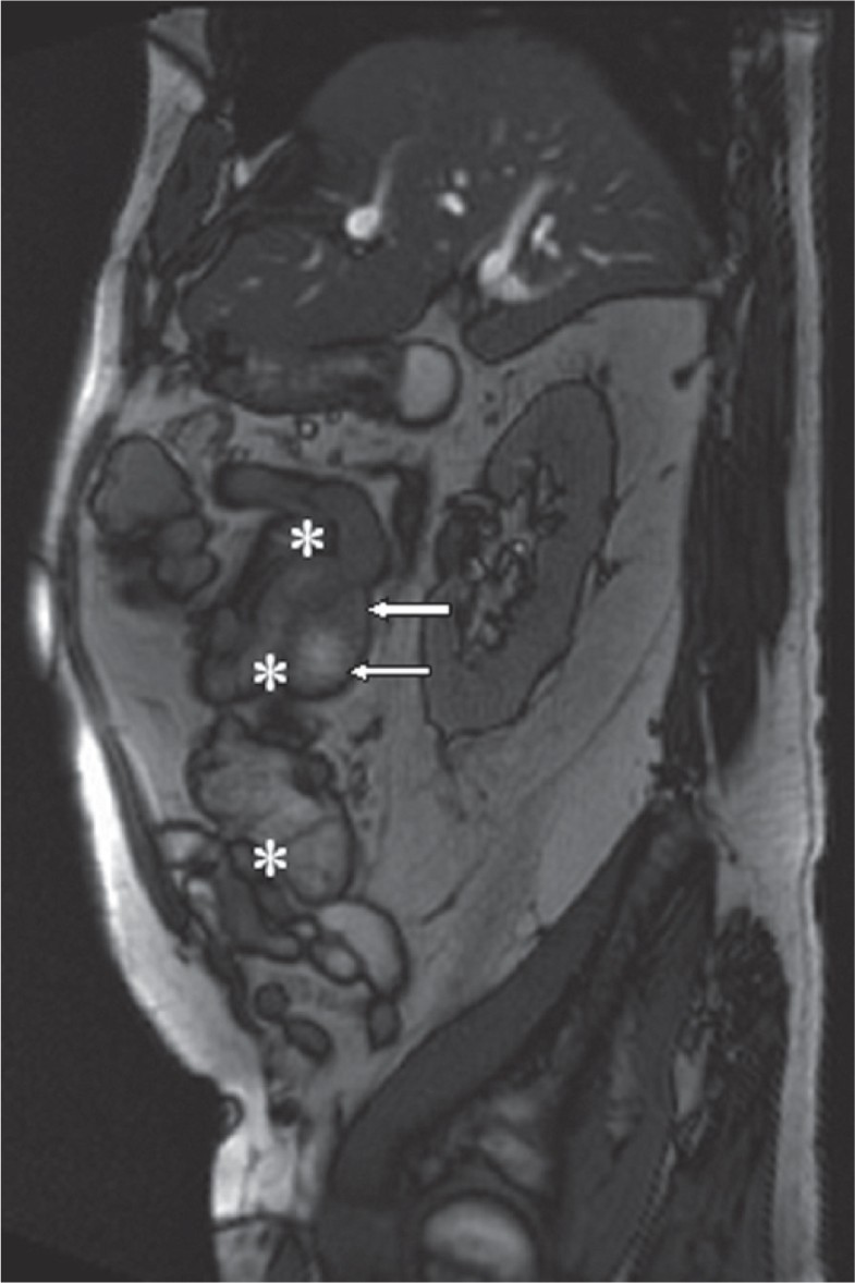 MRI of Adhesions and Small Bowel Obstruction | SpringerLink
