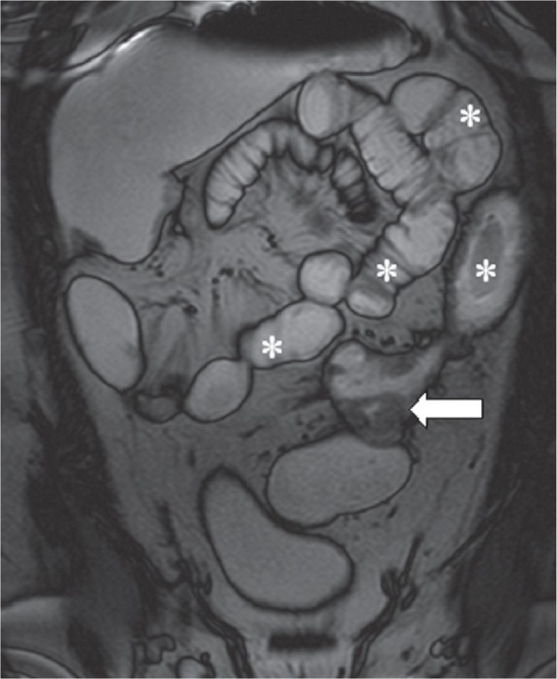 MRI of Adhesions and Small Bowel Obstruction | SpringerLink