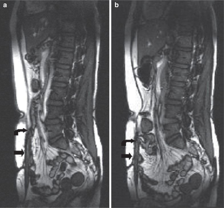 MRI of Adhesions and Small Bowel Obstruction | SpringerLink