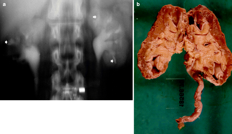 Obstructive Uropathy, Pyonephrosis, and Reflux Nephropathy in Adults ...