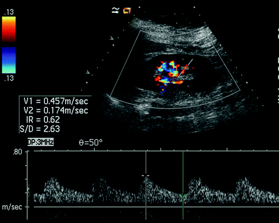 Normal Radiological Anatomy and Anatomical Variants of the Kidney ...