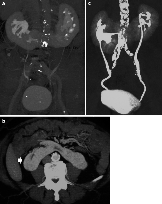 Normal Radiological Anatomy and Anatomical Variants of the Kidney ...