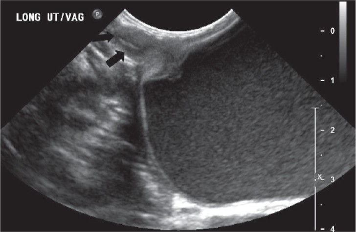 Hematometrocolpos (Hydrometrocolpos) | SpringerLink