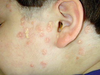 Papulosquamous and Related Disorders Including Psoriasis | SpringerLink