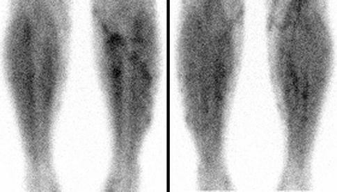 Soft Tissue Uptake in Radionuclide Bone Scintigraphy | SpringerLink