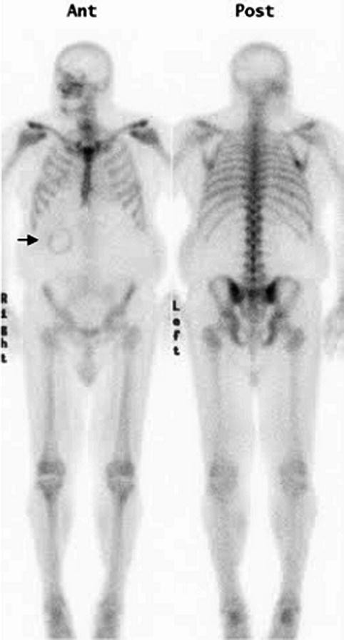 Soft Tissue Uptake in Radionuclide Bone Scintigraphy | SpringerLink