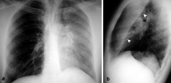 Atelectasis (Lung Collapse) | SpringerLink