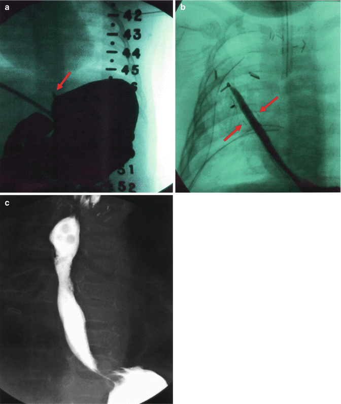 Growth Induction (the Foker Procedure) and a Flexible Approach for the ...