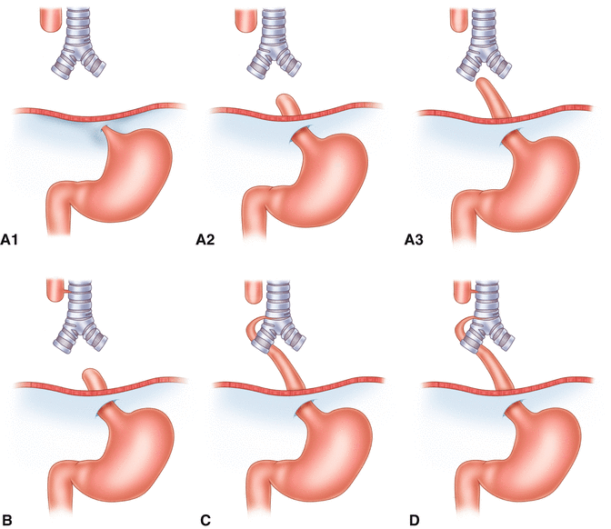 Growth Induction (the Foker Procedure) and a Flexible Approach for the ...