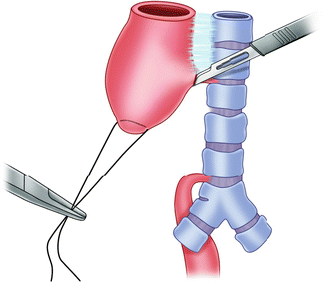 Growth Induction (the Foker Procedure) and a Flexible Approach for the ...
