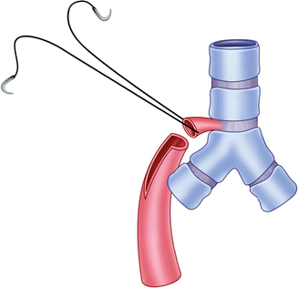 Growth Induction (the Foker Procedure) and a Flexible Approach for the ...