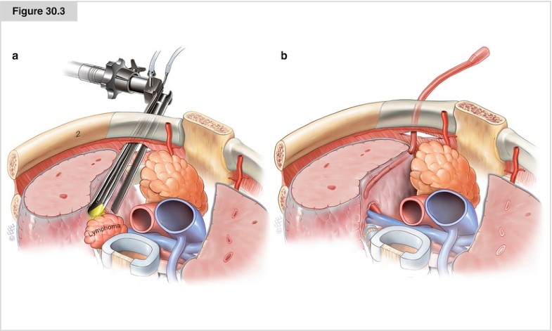Mediastinotomy | SpringerLink
