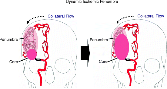 The Clinical Ischemic Penumbra | SpringerLink