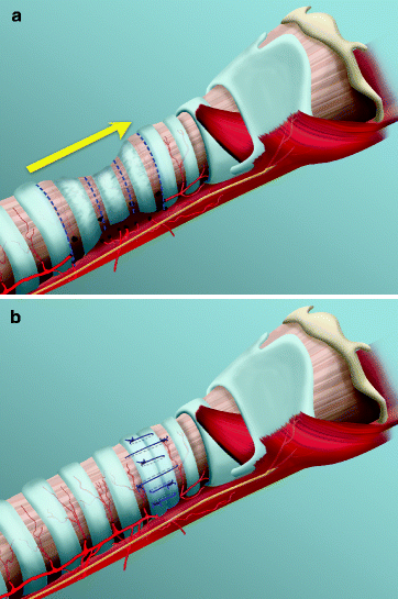 Tracheal Resection and Anastomosis | SpringerLink