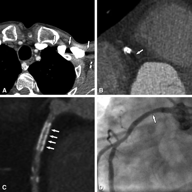 Coronary Artery Stents | SpringerLink